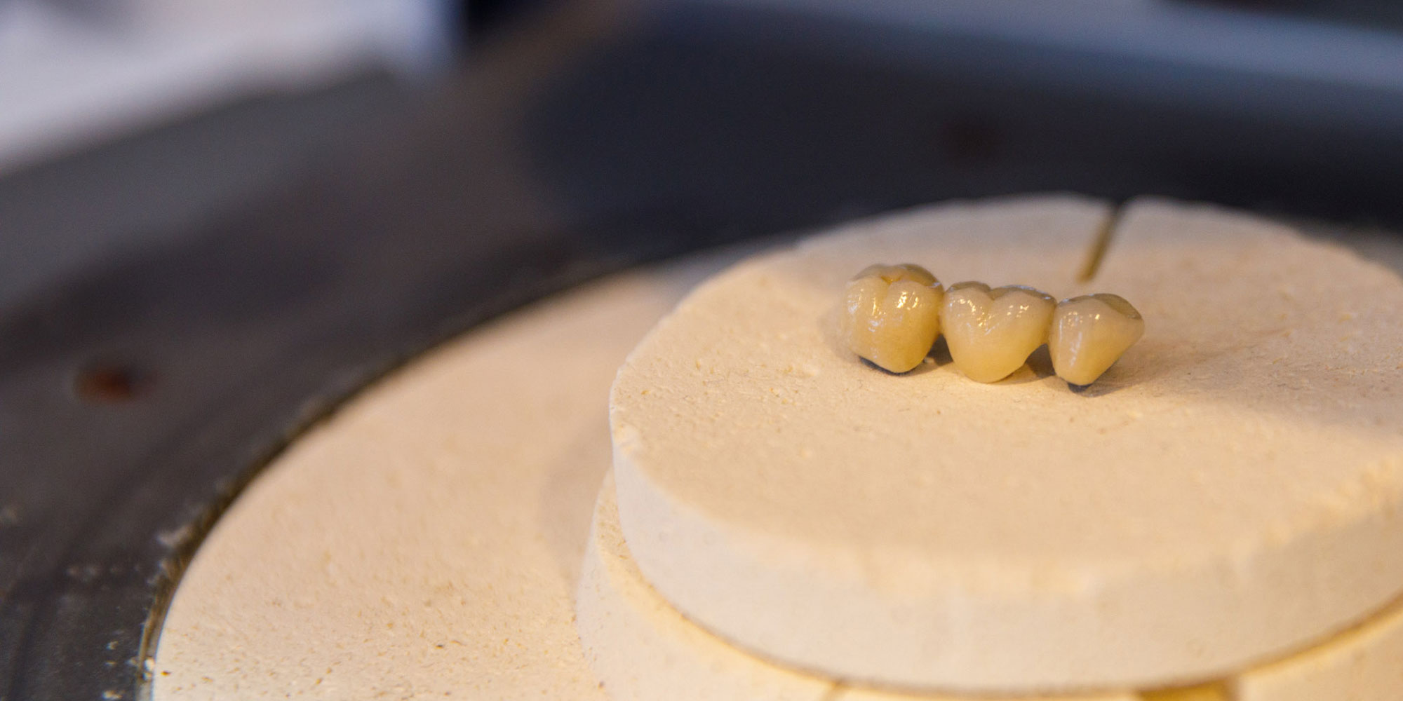 Zirconia Fixed Bridge | Plymouth, MA | Rizkalla Dental Associates